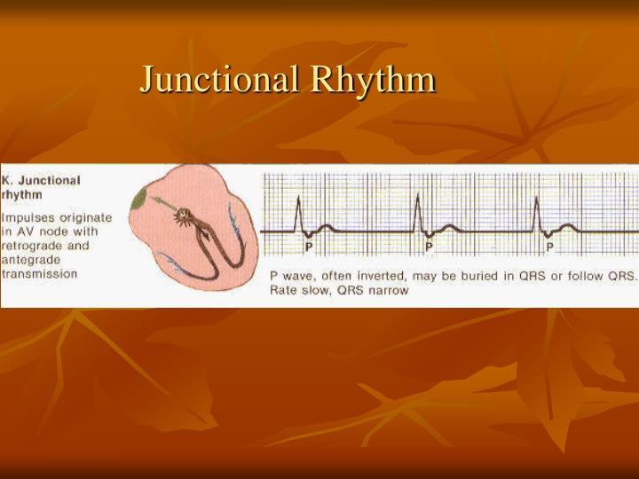 PPT - DIAGNOSIS OF CARDIAC RHYTHMS PowerPoint Presentation - ID:4749015