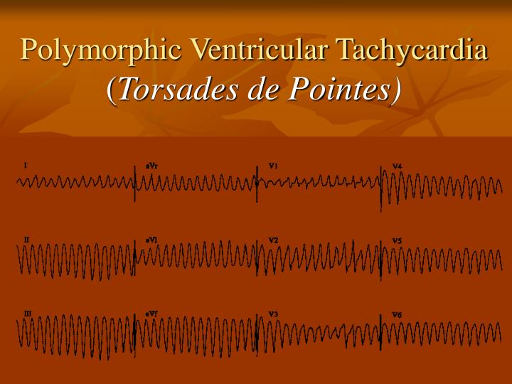 PPT - DIAGNOSIS OF CARDIAC RHYTHMS PowerPoint Presentation - ID:4749015