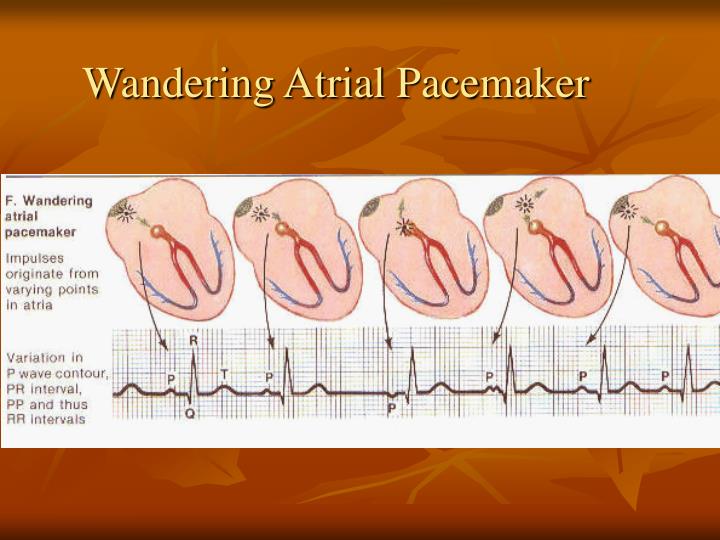 PPT - DIAGNOSIS OF CARDIAC RHYTHMS PowerPoint Presentation - ID:4749015