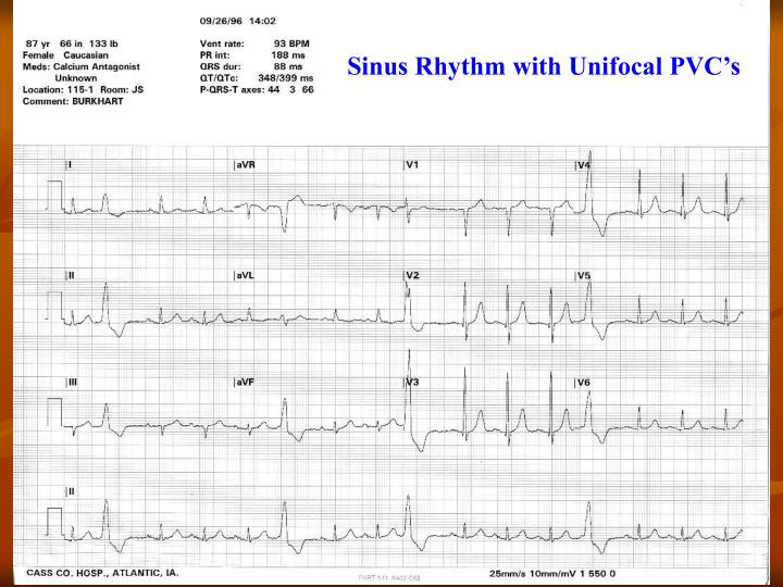 PPT - DIAGNOSIS OF CARDIAC RHYTHMS PowerPoint Presentation - ID:4749015
