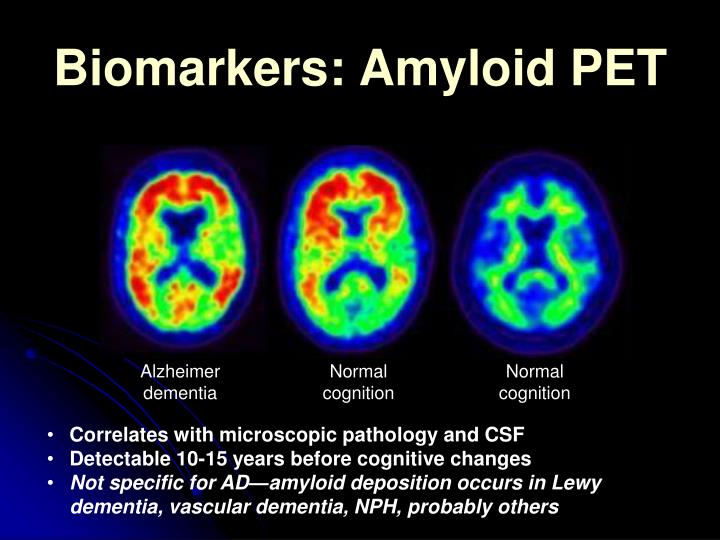 PPT - Dementia Update PowerPoint Presentation - ID:4749577