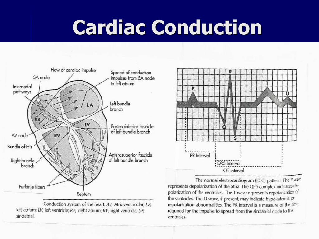 PPT - Coronary Artery Disease Complications Cardiac Arrhythmias ...