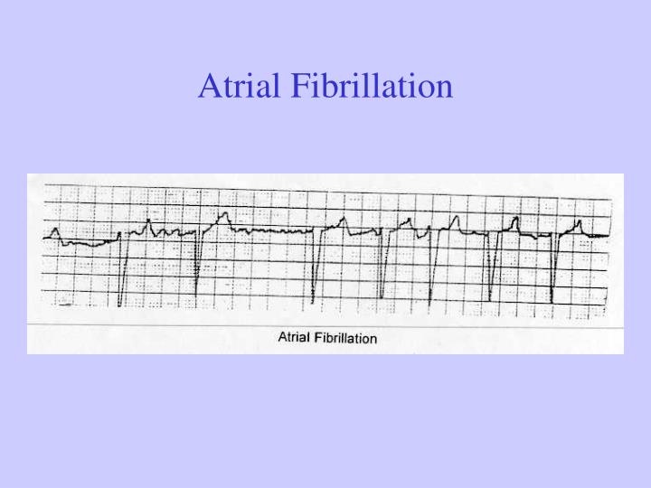 PPT - Supraventricular Arrhythmia PowerPoint Presentation - ID:4749656