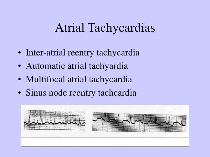PPT - Supraventricular Arrhythmia PowerPoint Presentation - ID:4749656