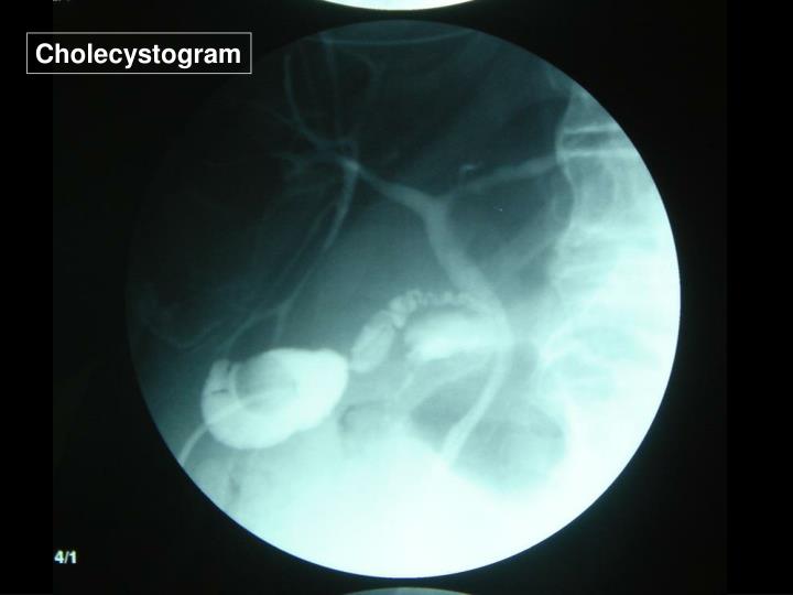 PPT - Biliary Pathology PowerPoint Presentation - ID:4749852