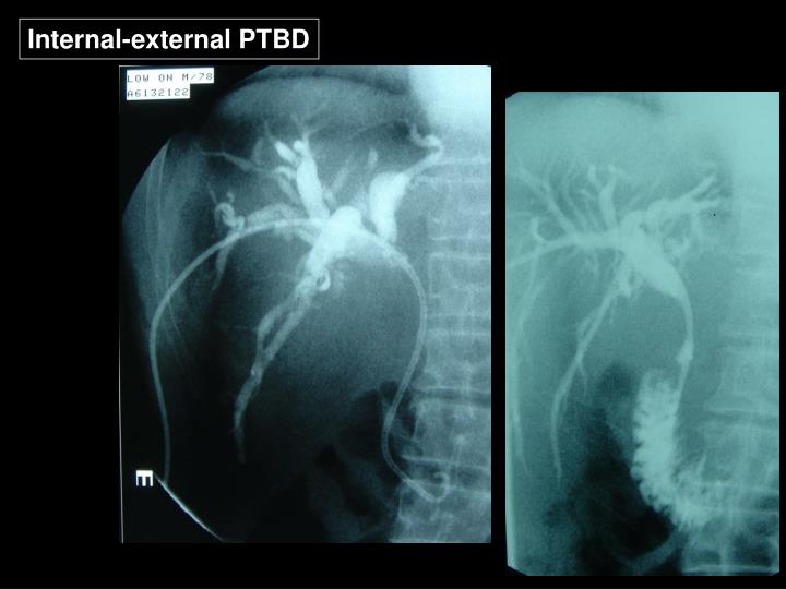 PPT - Biliary Pathology PowerPoint Presentation - ID:4749852