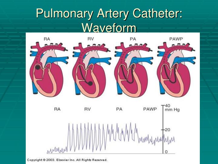PPT - Hemodynamic Monitoring PowerPoint Presentation - ID:4750943