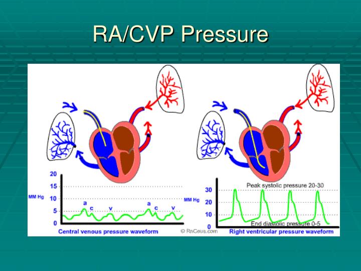 PPT - Hemodynamic Monitoring PowerPoint Presentation - ID:4750943