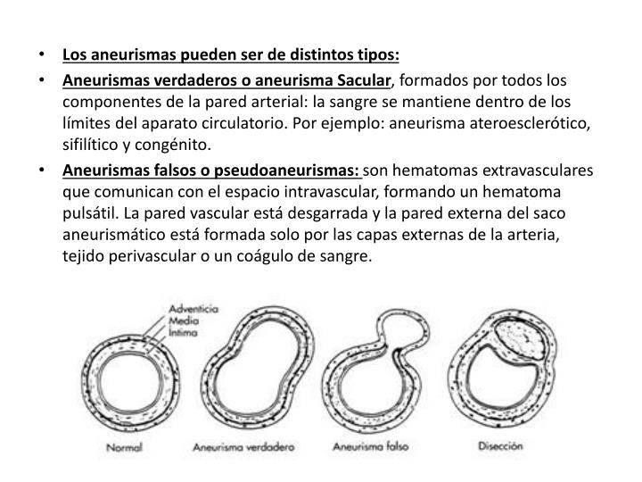 PPT - ANEURISMAS PowerPoint Presentation - ID:4756455