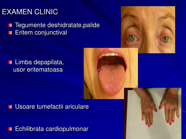 PPT - Sindromul Sjogren de la Sindrom sicca la Mielom Multiplu ...
