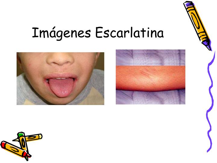 PPT - ENFERMEDADES EXANTEMATICAS PowerPoint Presentation - ID:4761652