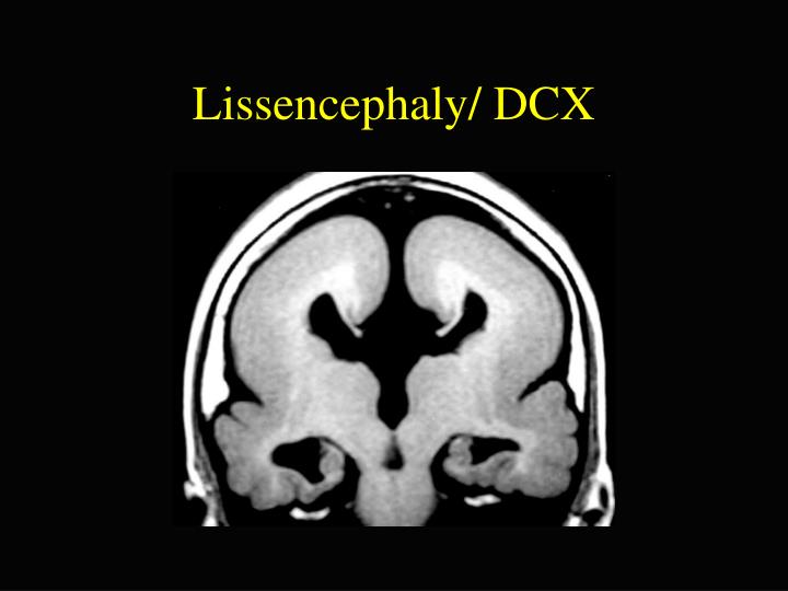 PPT - Neuroimaging of Epilepsy PowerPoint Presentation - ID:4764830