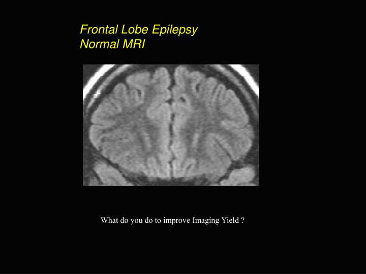 PPT - Neuroimaging of Epilepsy PowerPoint Presentation - ID:4764830