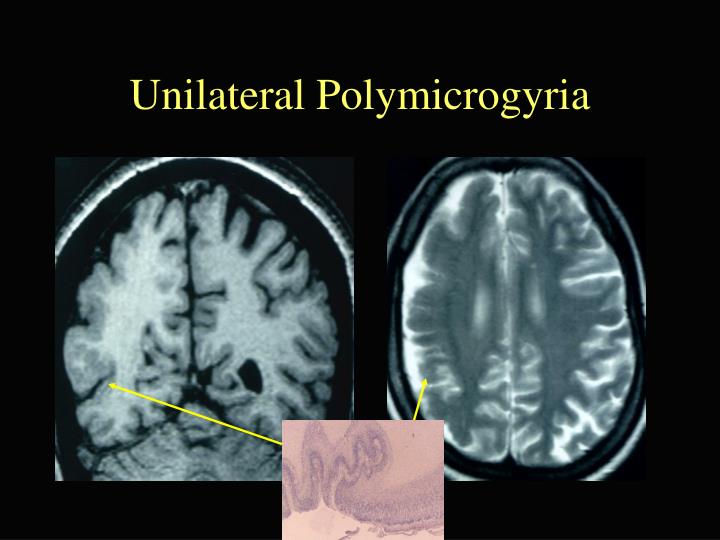 PPT - Neuroimaging of Epilepsy PowerPoint Presentation - ID:4764830