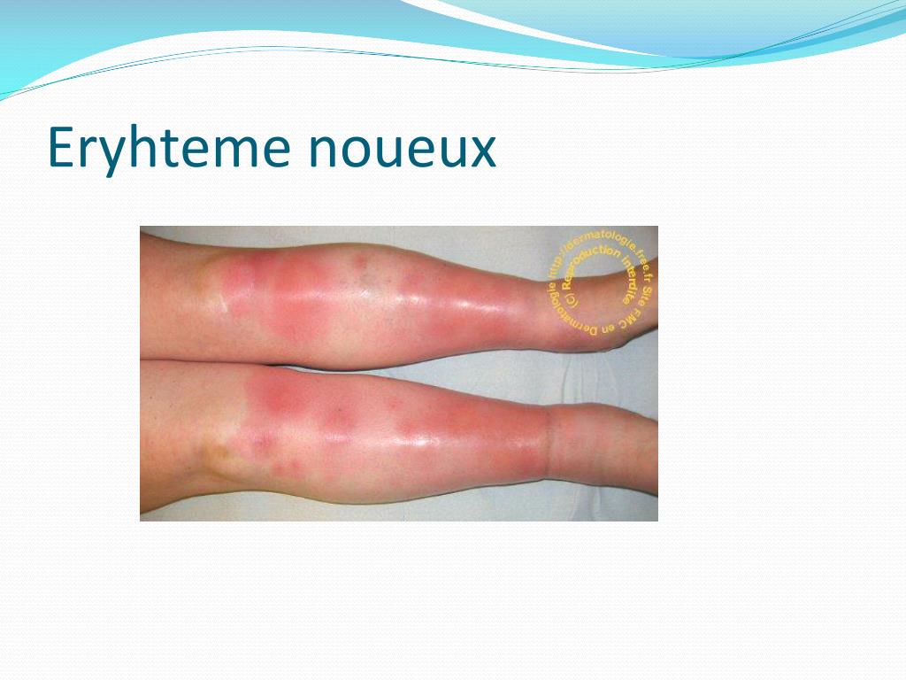 PPT - Maladies inflammatoires chroniques de l’intestin PowerPoint ...