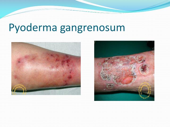 PPT - Maladies inflammatoires chroniques de l’intestin PowerPoint ...