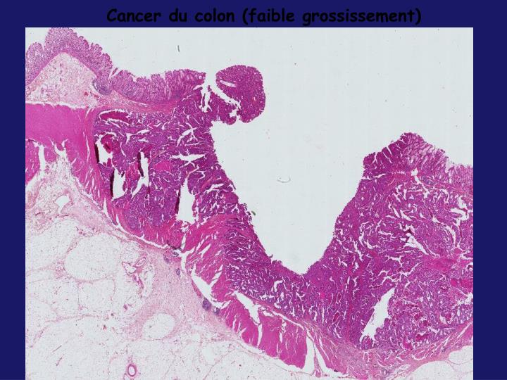 PPT - Histoire Naturelle du Cancer PowerPoint Presentation - ID:4767226