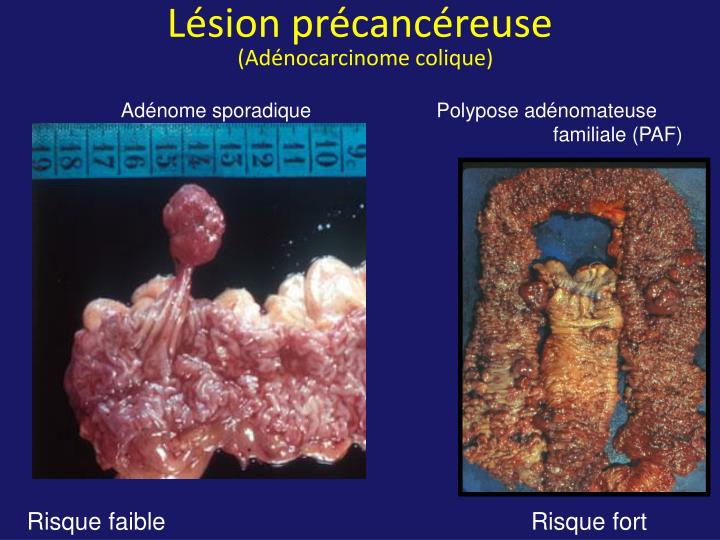 PPT - Histoire Naturelle du Cancer PowerPoint Presentation - ID:4767226