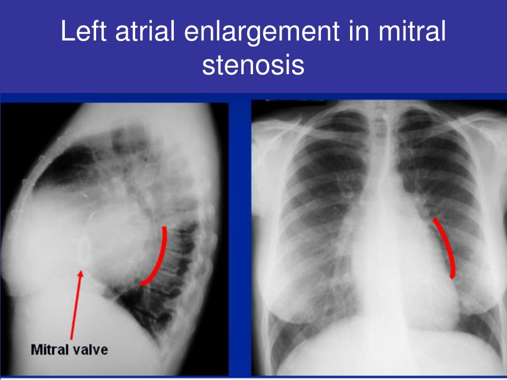 Ppt Normal Chest X Ray Powerpoint Presentation Free Download Id