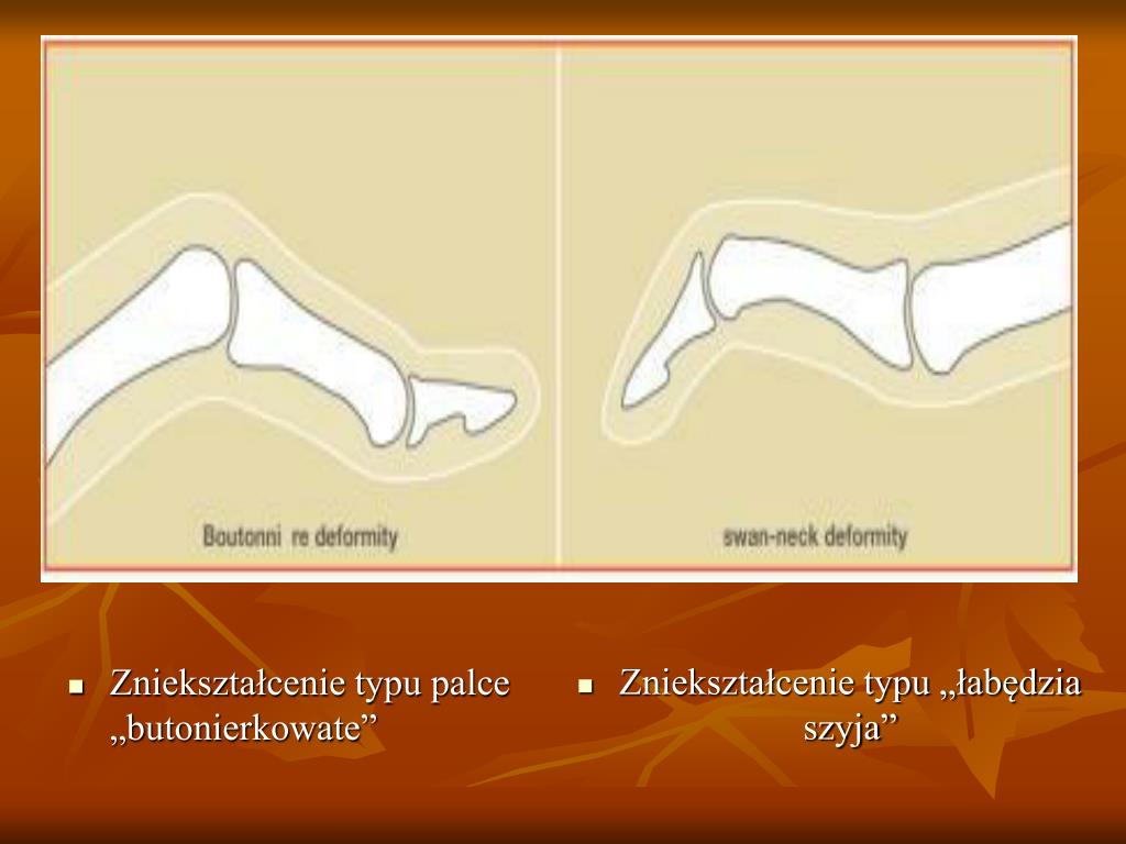 PPT - Akademia Medyczna im. Piastów Śląskich we Wrocławiu Reumatoidalne ...