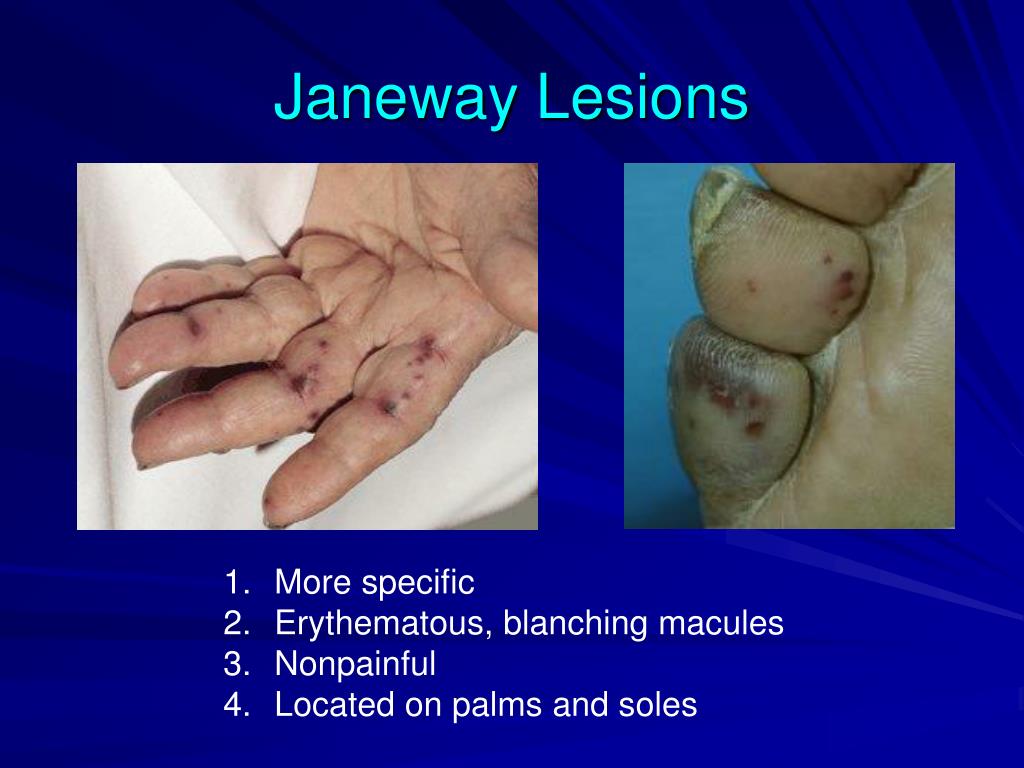 PPT Infective Endocarditis PowerPoint Presentation Free Download PPT Infective Endocarditis PowerPoint Presentation Free Download