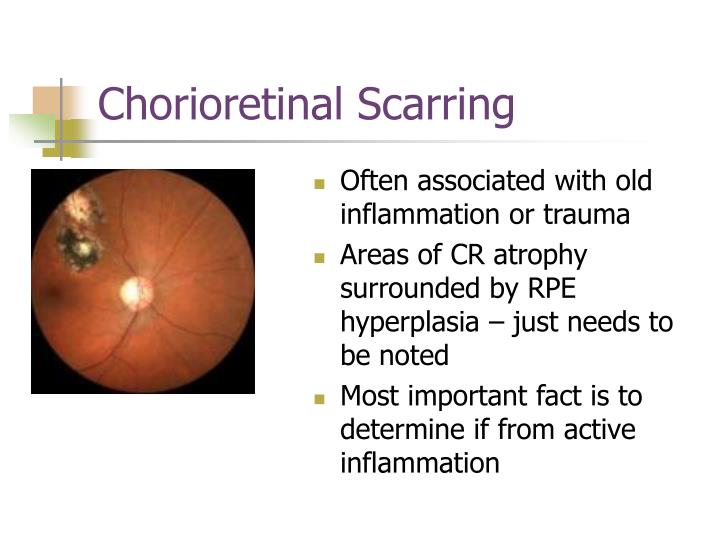 PPT - Vitreous & Peripheral Retinal Anomalies PowerPoint Presentation ...