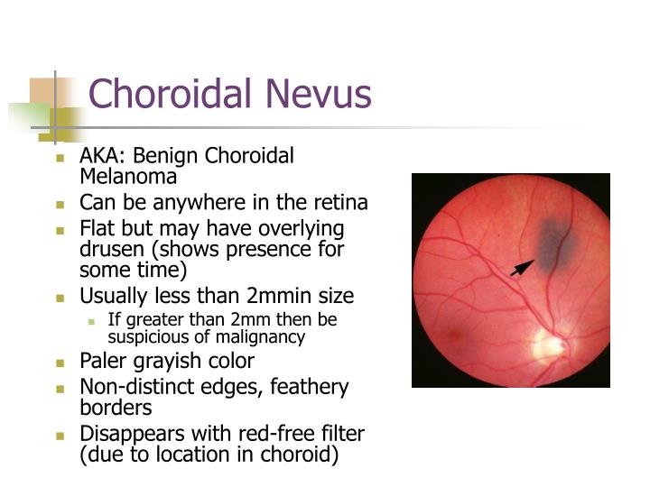 PPT - Vitreous & Peripheral Retinal Anomalies PowerPoint Presentation ...