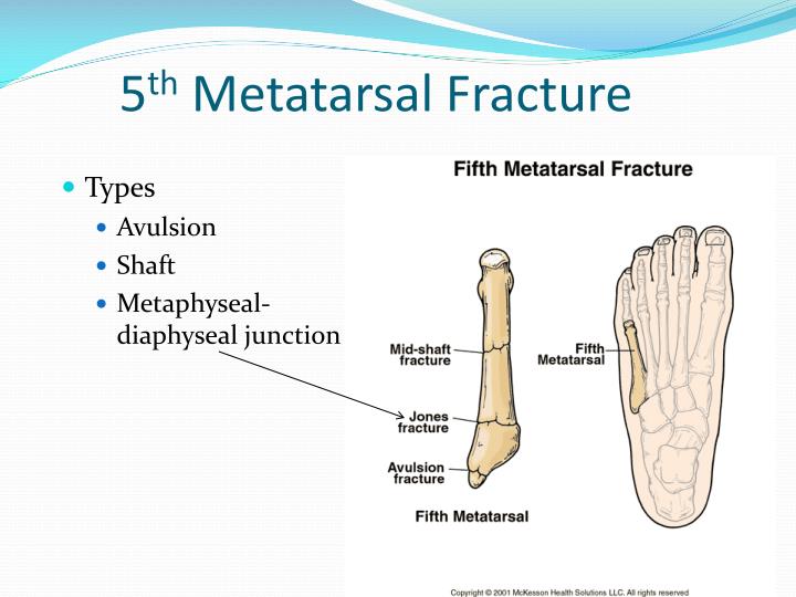 PPT - Common Fracture Management PowerPoint Presentation - ID:4789115