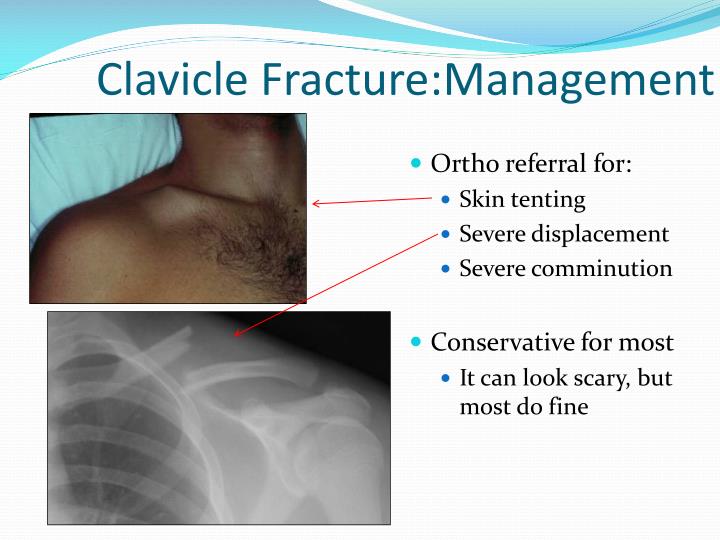 PPT - Common Fracture Management PowerPoint Presentation - ID:4789115