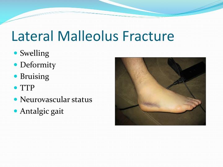 PPT - Common Fracture Management PowerPoint Presentation - ID:4789115