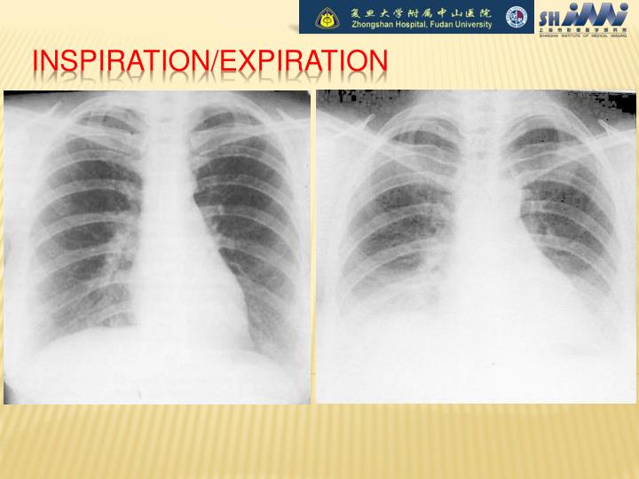 PPT - Radiology of Respiratory System PowerPoint Presentation - ID:4792657