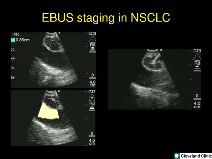 PPT - Clinical utilization of endobronchial ultrasound (EBUS) to stage ...