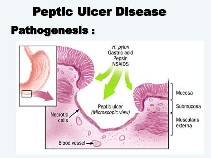 PPT - Peptic Ulcer Disease PowerPoint Presentation - ID:4796484