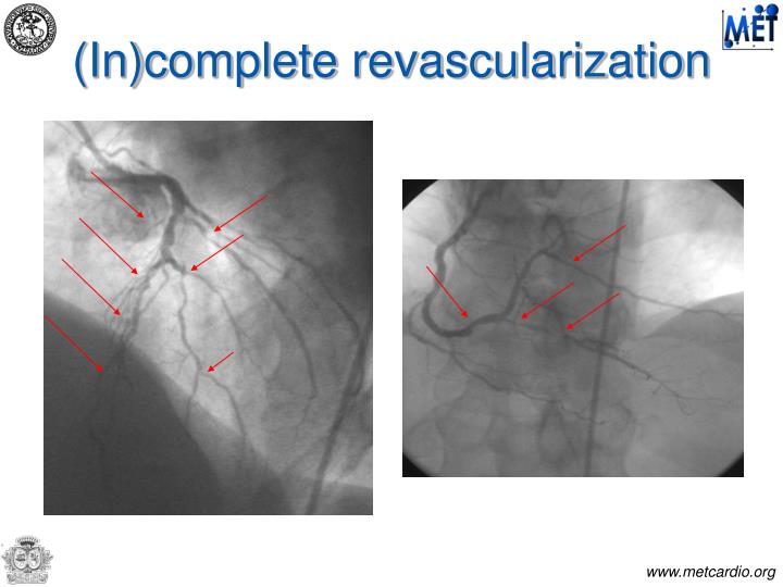 PPT - REFRACTORY ANGINA : Definition, epidemiology, and management ...