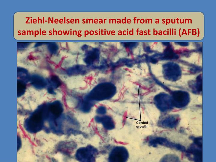 PPT - Mycobacterium tuberculosis & pulmonary tuberculosis PowerPoint ...