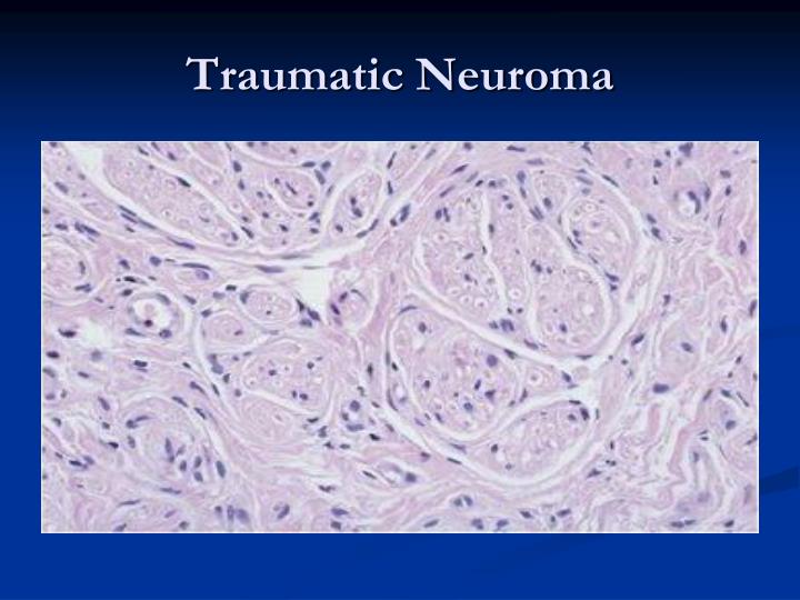 PPT - Traumatic fibroma PowerPoint Presentation - ID:4803635