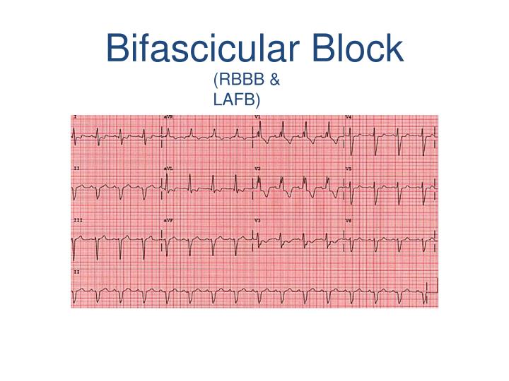 PPT - Bundle Branch Blocks PowerPoint Presentation - ID:4807495