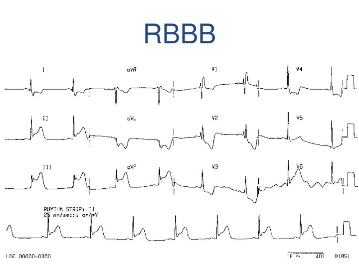 PPT - Bundle Branch Blocks PowerPoint Presentation - ID:4807495