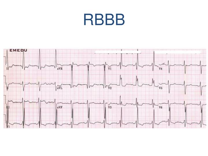 PPT - Bundle Branch Blocks PowerPoint Presentation - ID:4807495