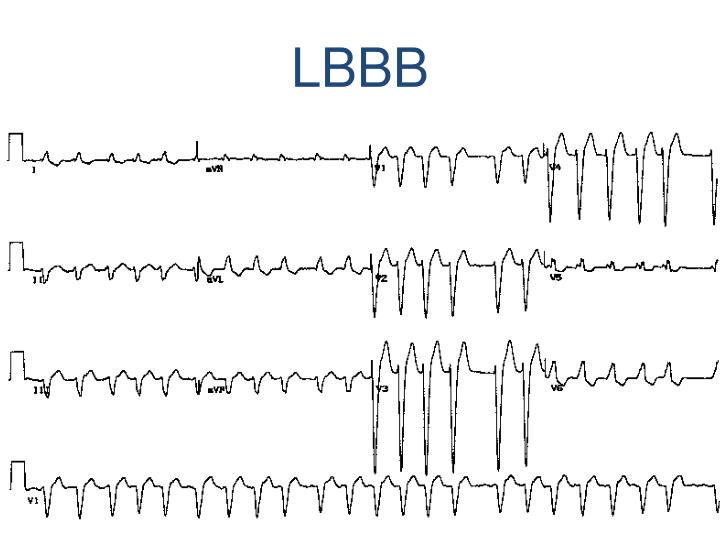 PPT - Bundle Branch Blocks PowerPoint Presentation - ID:4807495