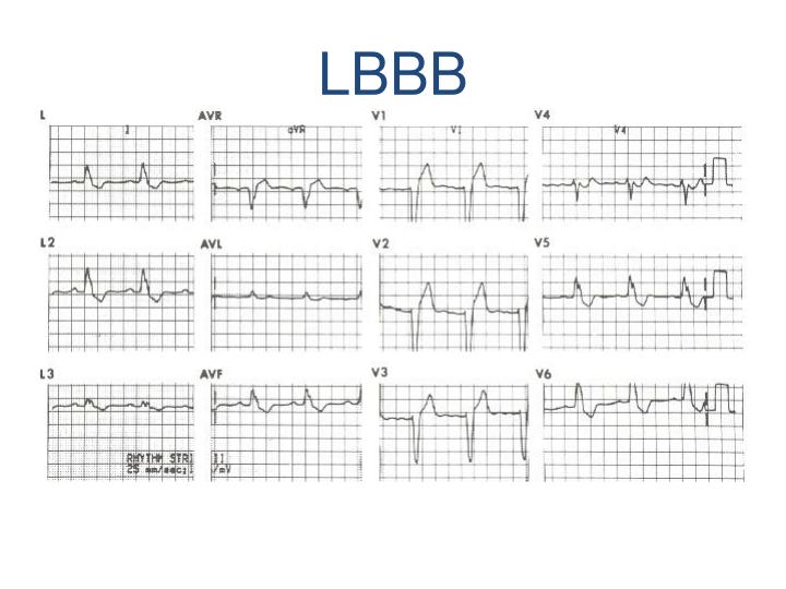 PPT - Bundle Branch Blocks PowerPoint Presentation - ID:4807495