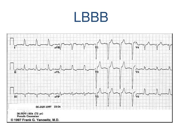 PPT - Bundle Branch Blocks PowerPoint Presentation - ID:4807495