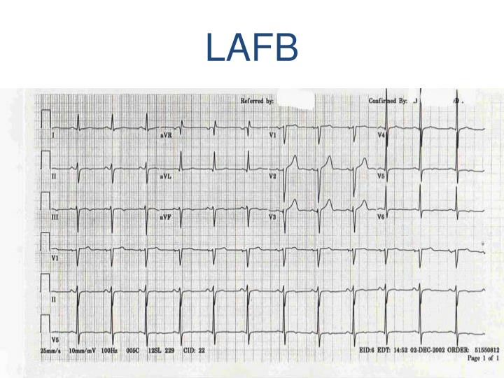 PPT - Bundle Branch Blocks PowerPoint Presentation - ID:4807495