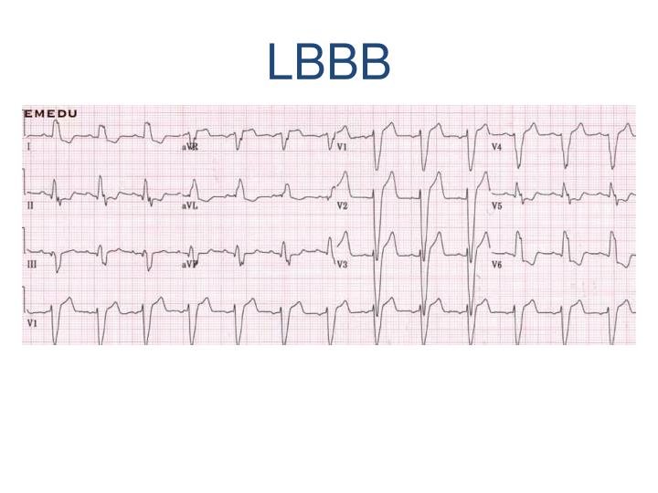 PPT - Bundle Branch Blocks PowerPoint Presentation - ID:4807495