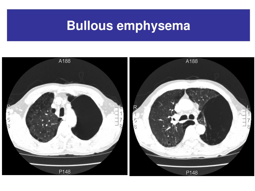 PPT - 13. Annual Congress Turkish Thoracic Society 5. – 9. May 2010 ...
