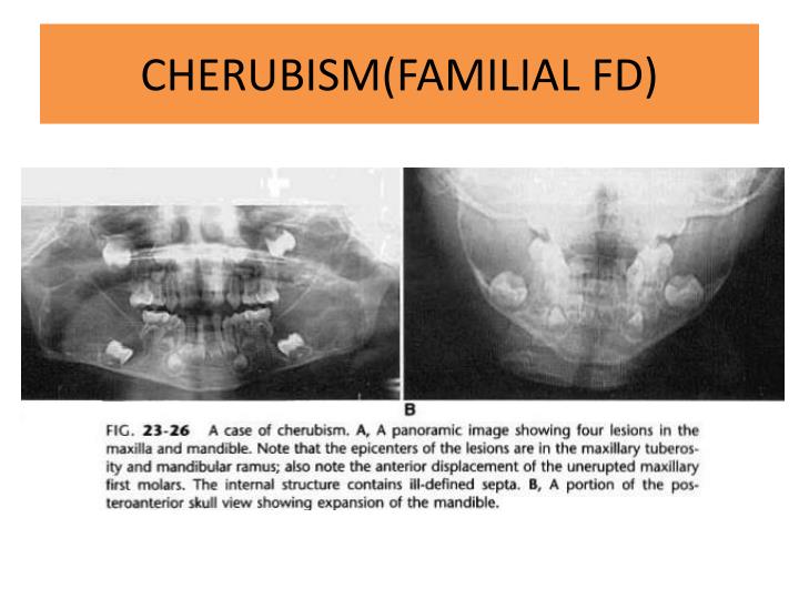 PPT - BONE DISEASES OF JAWS PowerPoint Presentation - ID:4809422
