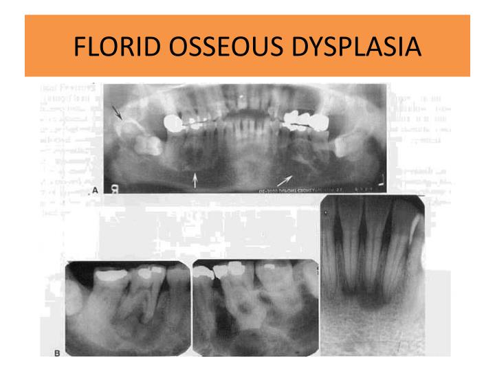 PPT - BONE DISEASES OF JAWS PowerPoint Presentation - ID:4809422