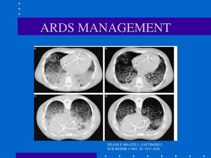 PPT - MANAGEMENT OF ARDS PowerPoint Presentation - ID:4810075