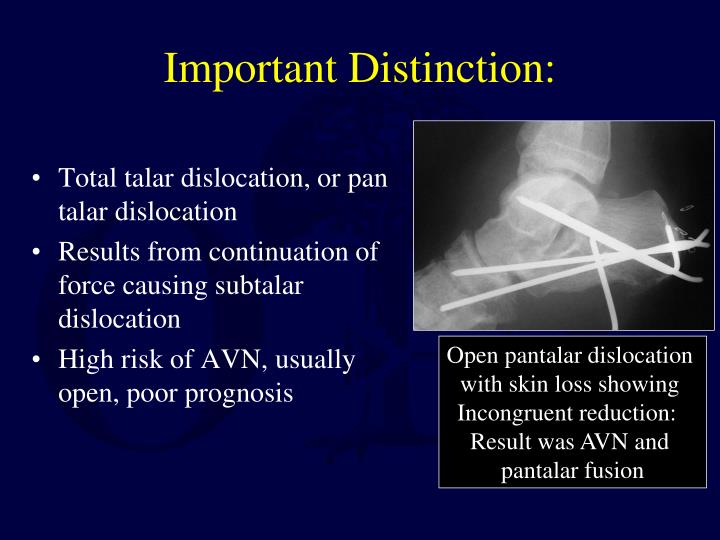 PPT - Fractures of the Talus and Subtalar Dislocations PowerPoint ...