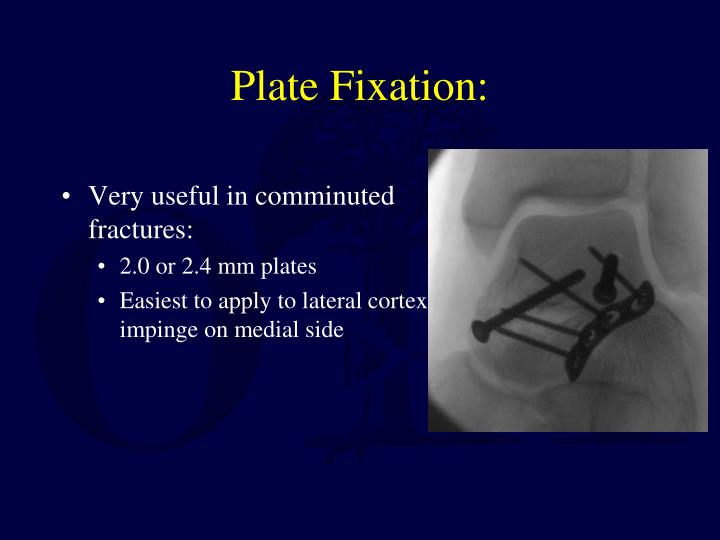 PPT - Fractures of the Talus and Subtalar Dislocations PowerPoint ...